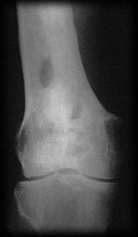 Osteomyelitis - GlobalRPH